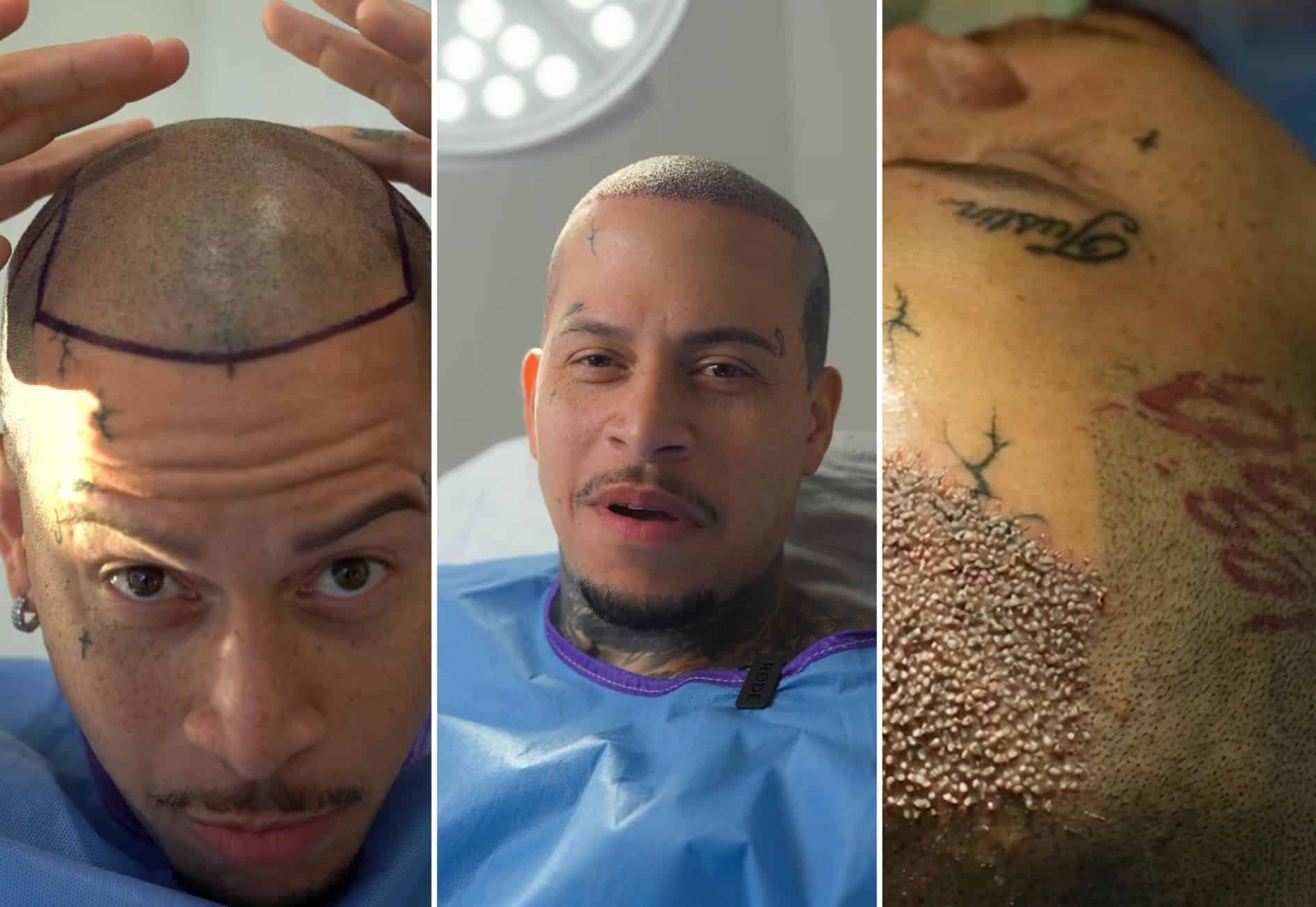 El Chulo también se somete a un trasplante capilar en Miami - Cuballama ...